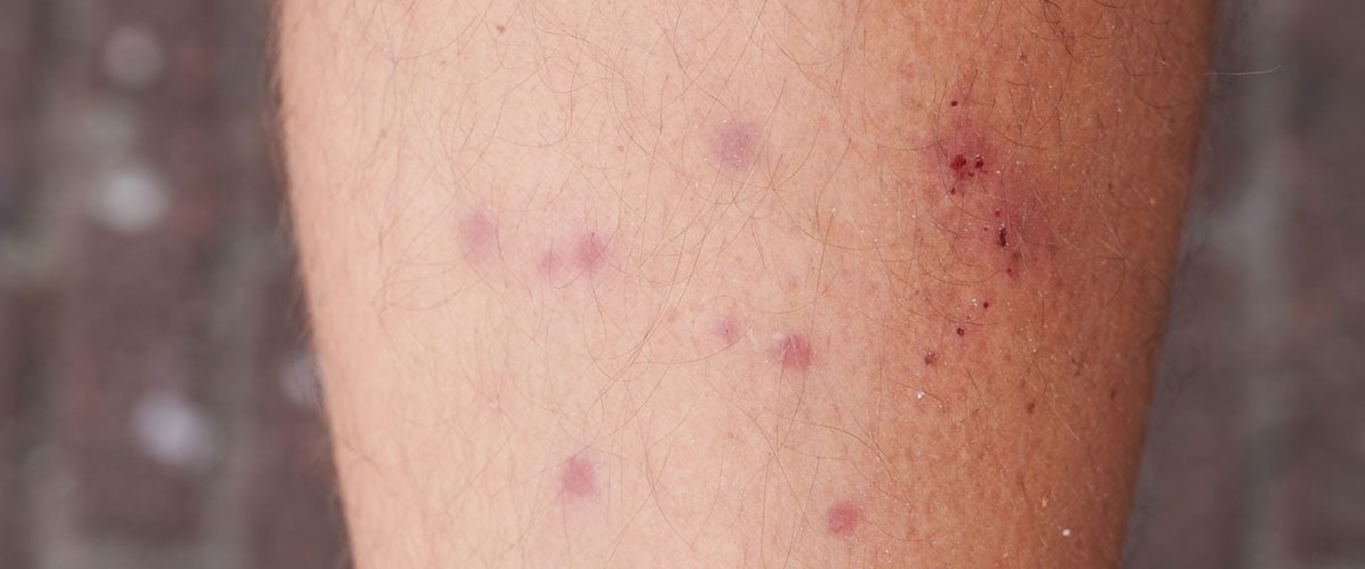 The Impact of Dust Mites on Human Health: A Comprehensive Guide